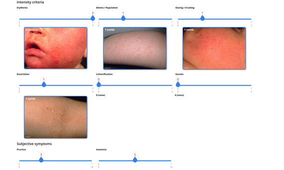 electronic Severity Scoring of Atopic Dermatitis - eSCORAD